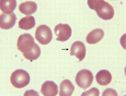 O que é Anemia Hemolítica - Hematologia na Bancada